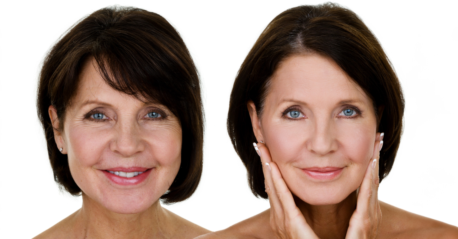 Lifting cervicofacial | Doctor Galindo